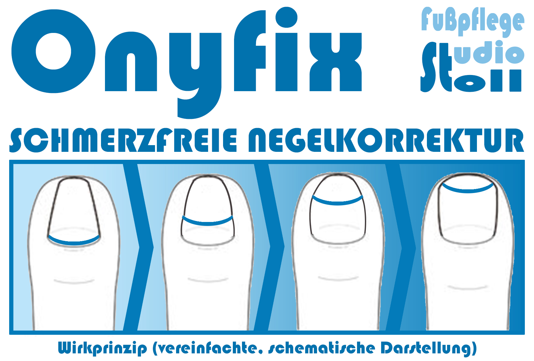 Onyfix Nagelkorrektur | Hilfe bei eingewachsenem Zehennagel